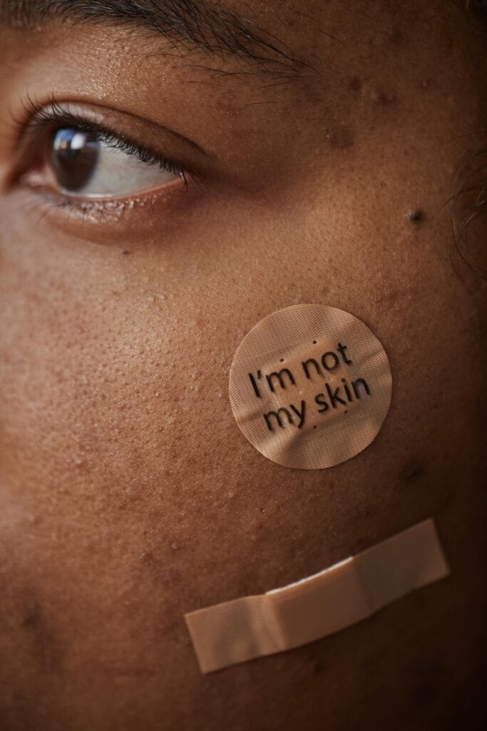 The Real Deal About Preventing Breakouts (Spoiler: Nobody’s Skin Is ...